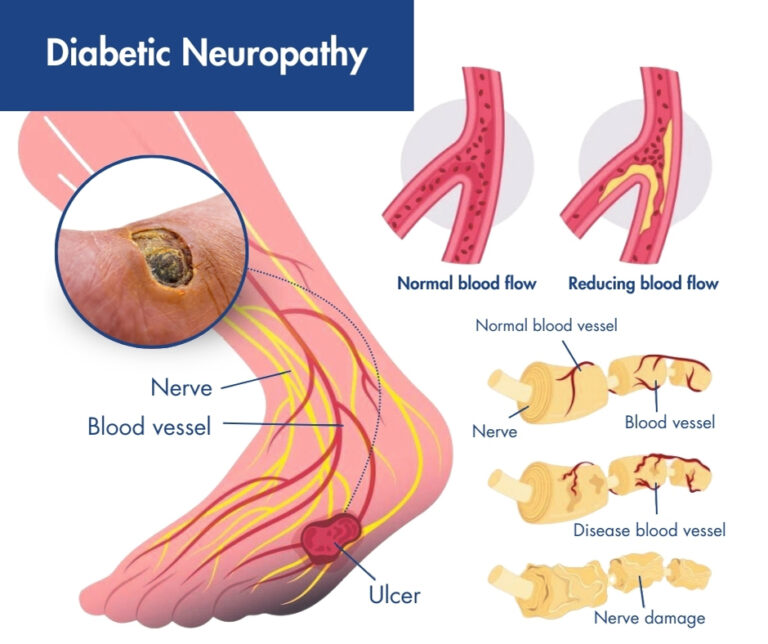 Diabetic Neuropathy Tests in Mumbai | VRX Healthcare